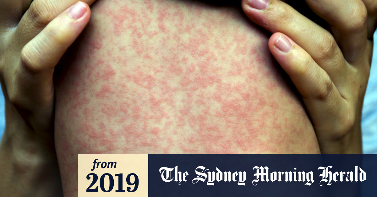 More than 900 dead in Madagascar measles epidemic More than 900 dead in Madagascar measles epidemic